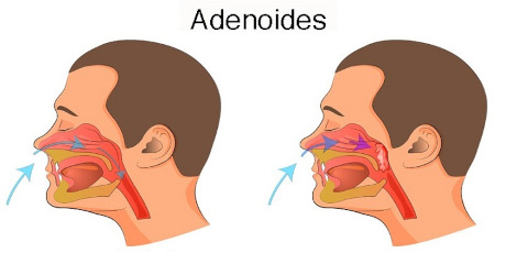 Live Chennai: KNOW EVERYTHING ABOUT ADENOIDITIS AND HOW CAN IT AFFECT YOU?,KNOW EVERYTHING ABOUT ...